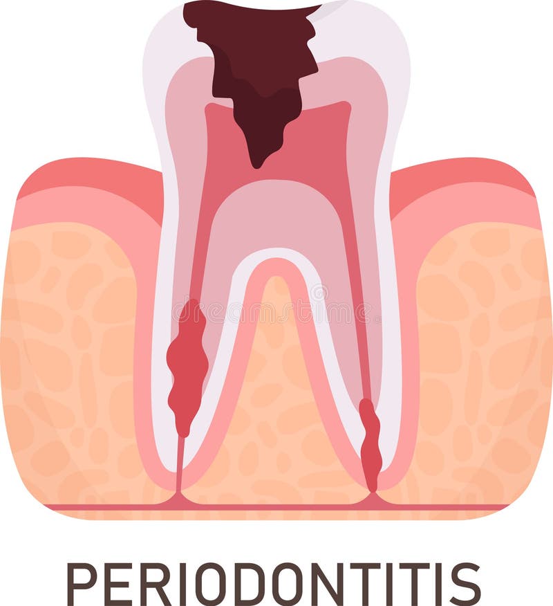 Periodontitis Tooth Problem Stock Vector - Illustration of oral ...