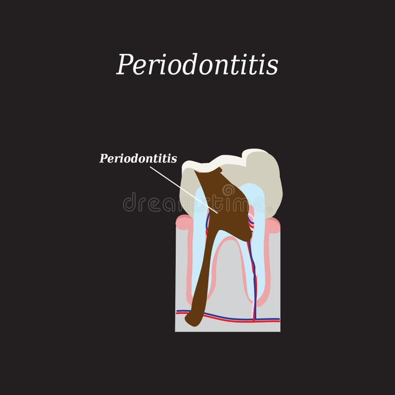 Periodontitis Tooth. Vector Illustration on a Stock Vector ...