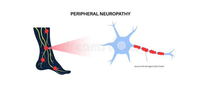 Diabetic Peripheral Neuropathy Foot Stock Illustrations – 57 Diabetic ... Diabetic Peripheral Neuropathy Foot Stock Illustrations – 57 Diabetic ...