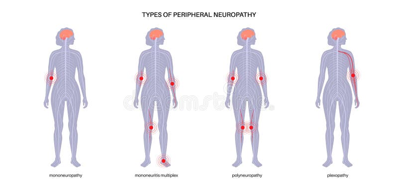 Plexopathy Stock Illustrations 2 Plexopathy Stock Illustrations
