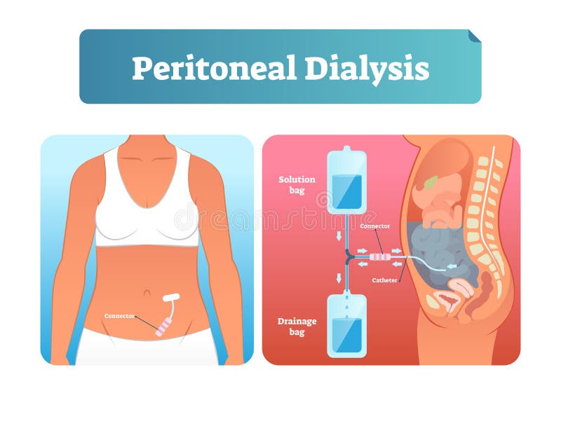 Continuous Ambulatory Peritoneal Dialysis Stock Vector - Illustration ...