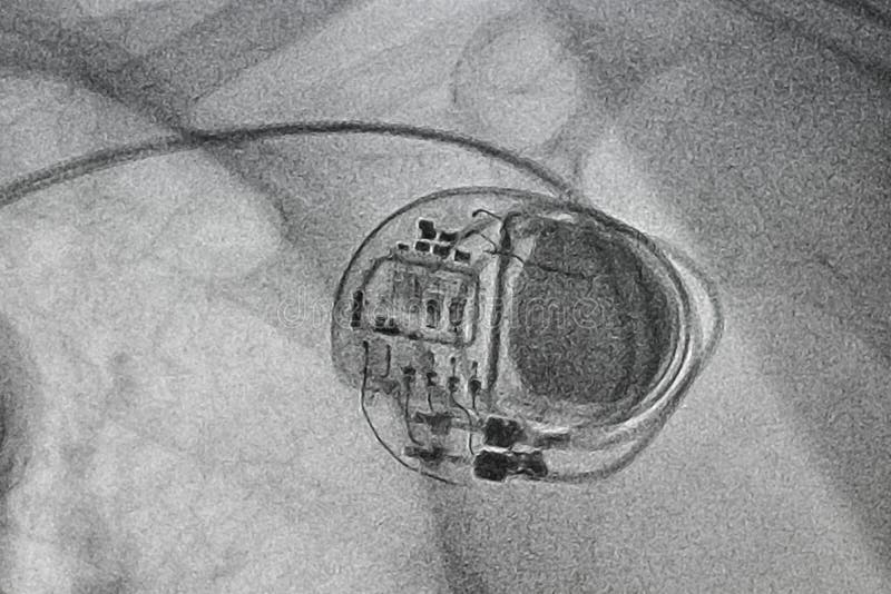 Permanent Beeld Van Pacemaker Stock Afbeelding - Image of ...