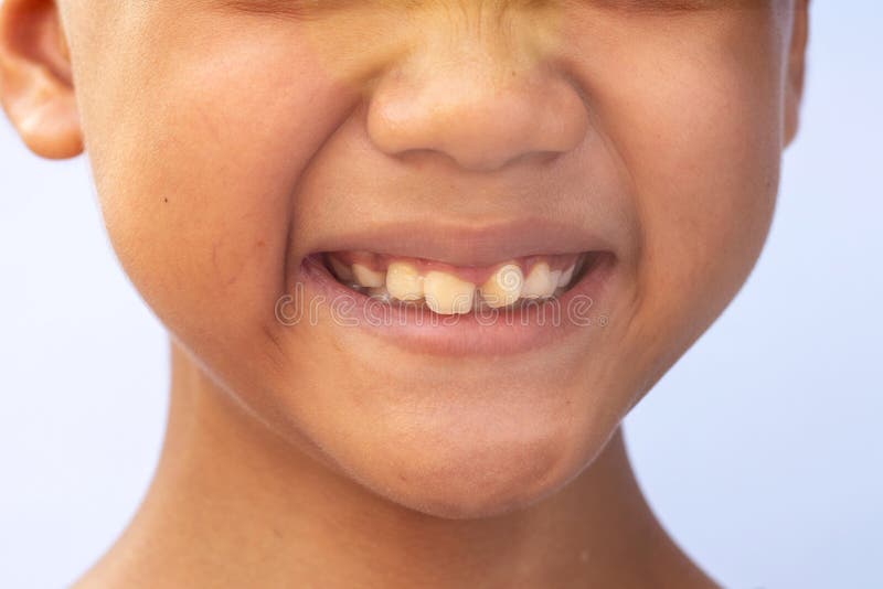 The Permanent Teeth in Front of Boys Aged 8 To 10 Years that are ...