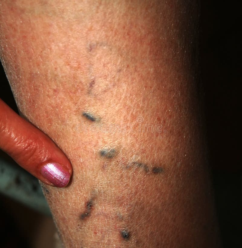 Perna. Veias Varicosas. Fleurismo. Tromboflebite. Perna Nas Veias Foto ...