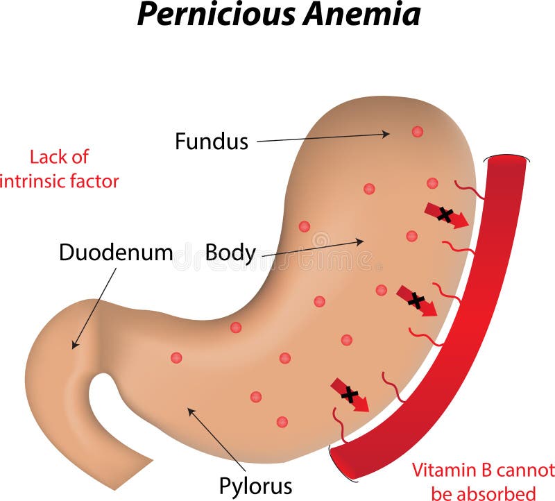 Anemia and its type - Overall Science