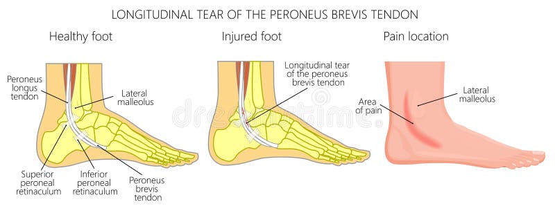 Peroneal Scheur Van Peesinjuries_longitudinal Van Peroneusbrevi Vector ...