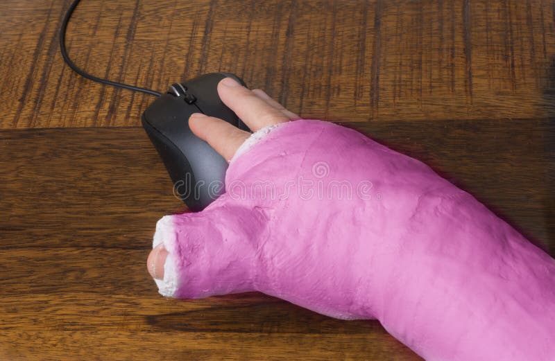 Person with Arm Cast Using a Computer Mouse Stock Photo - Image of ...