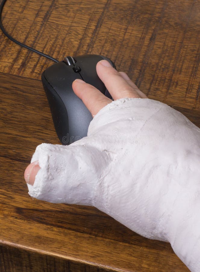 Person with Arm Cast Using a Computer Mouse Stock Photo - Image of note ...