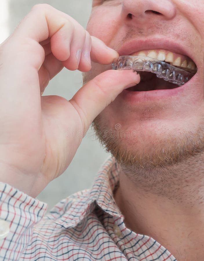 A Person Puts a Plastic Aligner Plate on His Teeth from Brcusism, a Cap ...