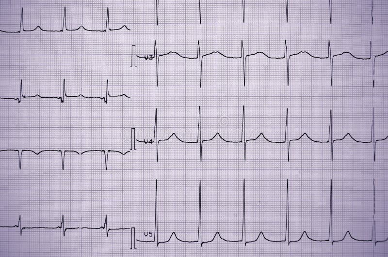 Persona sana de ECG imagen de archivo. Imagen de nadie - 28174021 Persona sana de ECG imagen de archivo. Imagen de nadie - 28174021