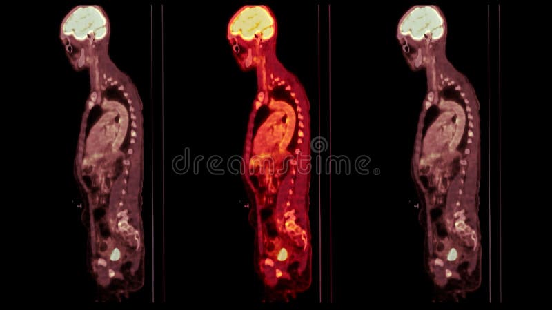 A PET-CT Scan Image is a Diagnostic Visualization Combining Positron ...