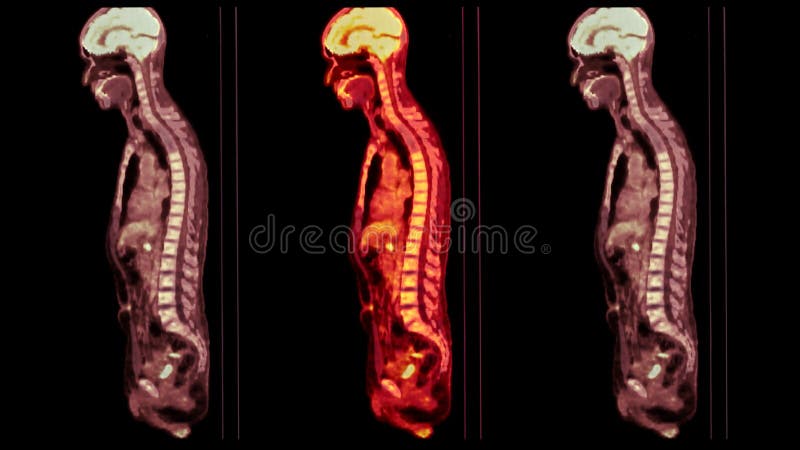A PET-CT Scan Image is a Diagnostic Visualization Combining Positron ...