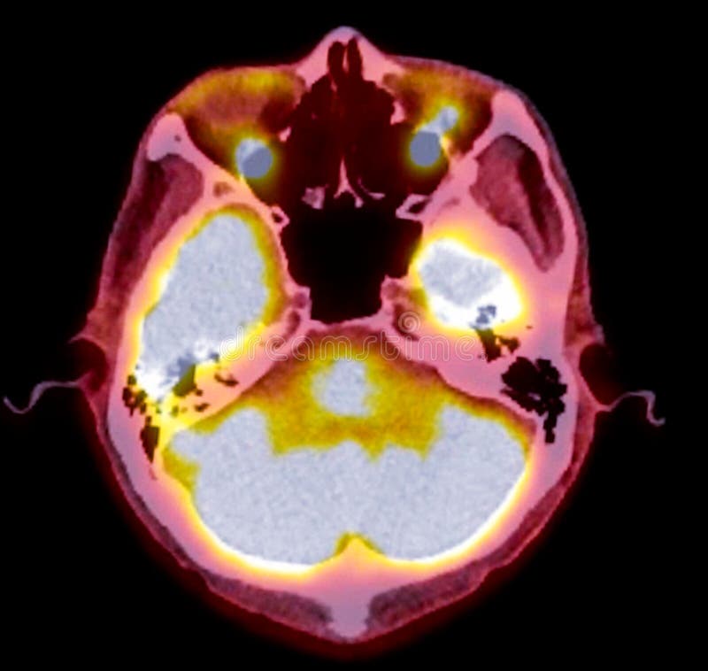 A PET-CT Scan Image is a Diagnostic Visualization Combining Positron ...