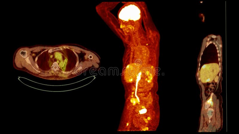 A PET-CT Scan Image is a Diagnostic Visualization Combining Positron ...