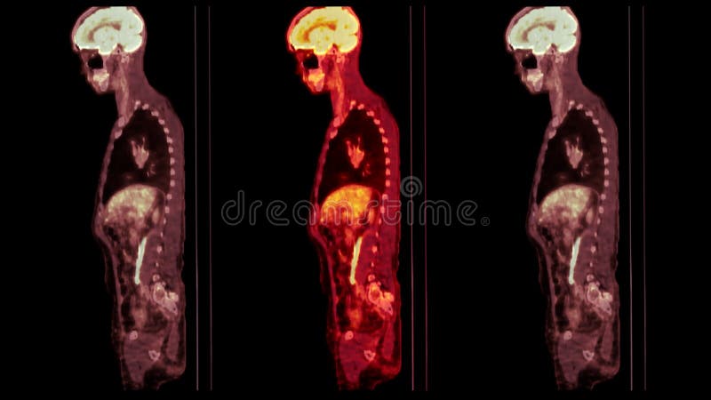 A PET-CT Scan Image is a Diagnostic Visualization Combining Positron ...