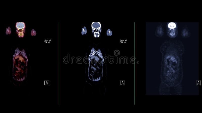 A PET-CT Scan Image is a Diagnostic Visualization Combining Positron ...