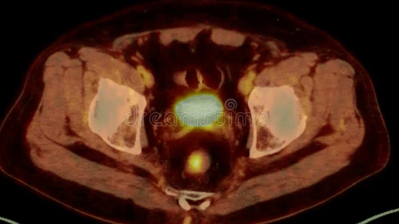 A PET-CT Scan Image is a Diagnostic Visualization Combining Positron ...