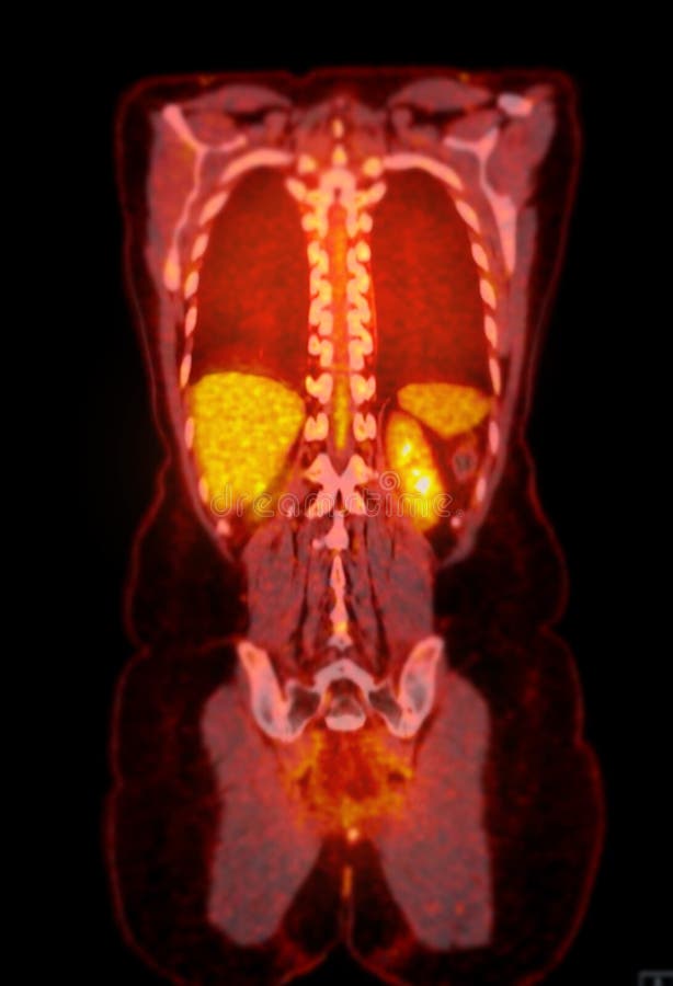 A PET-CT Scan Image is a Diagnostic Visualization Combining Positron ...