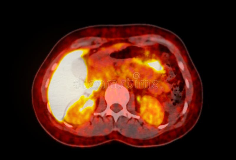A PET-CT Scan Image is a Diagnostic Visualization Combining Positron ...