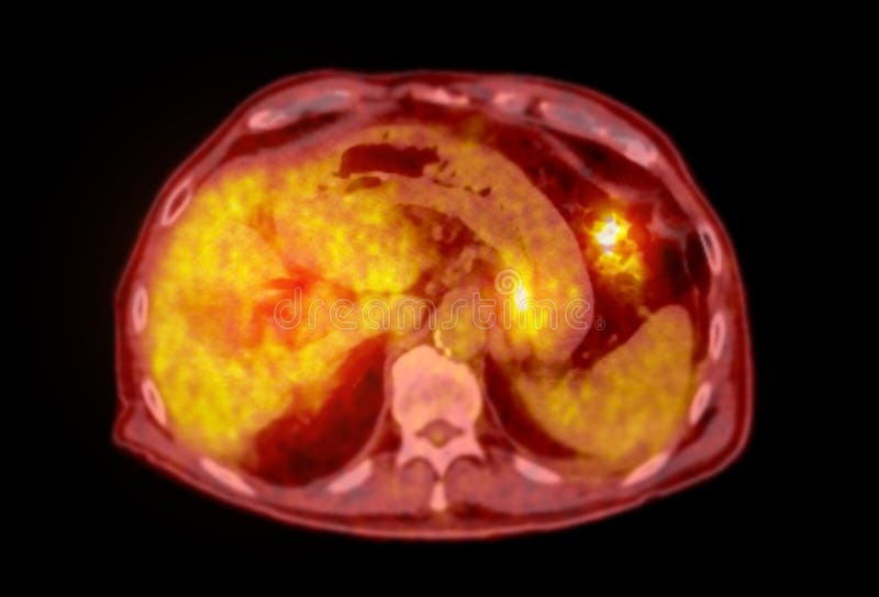 A PET-CT Scan Image is a Diagnostic Visualization Combining Positron ...