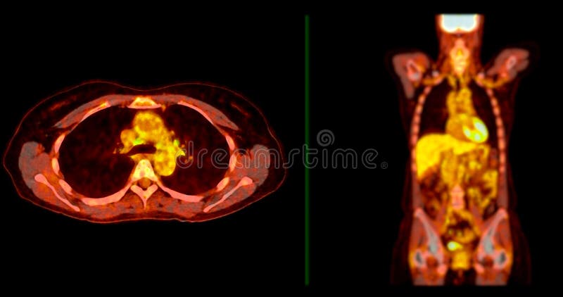 A PET-CT Scan Image is a Diagnostic Visualization Combining Positron ...