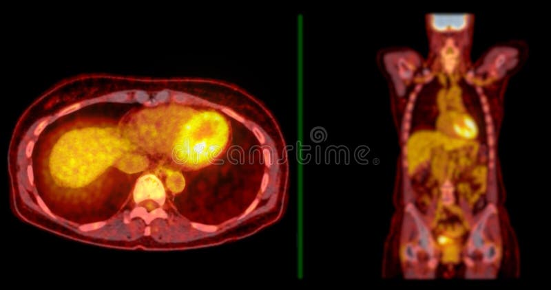 A PET-CT Scan Image is a Diagnostic Visualization Combining Positron ...