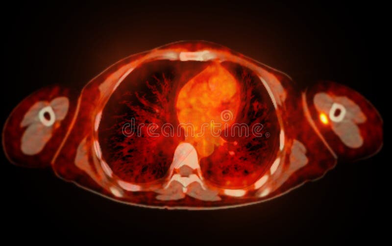 A PET-CT Scan Image is a Diagnostic Visualization Combining Positron ...