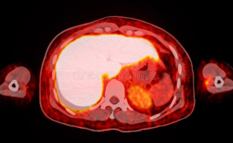 A PET-CT Scan Image is a Diagnostic Visualization Combining Positron ...