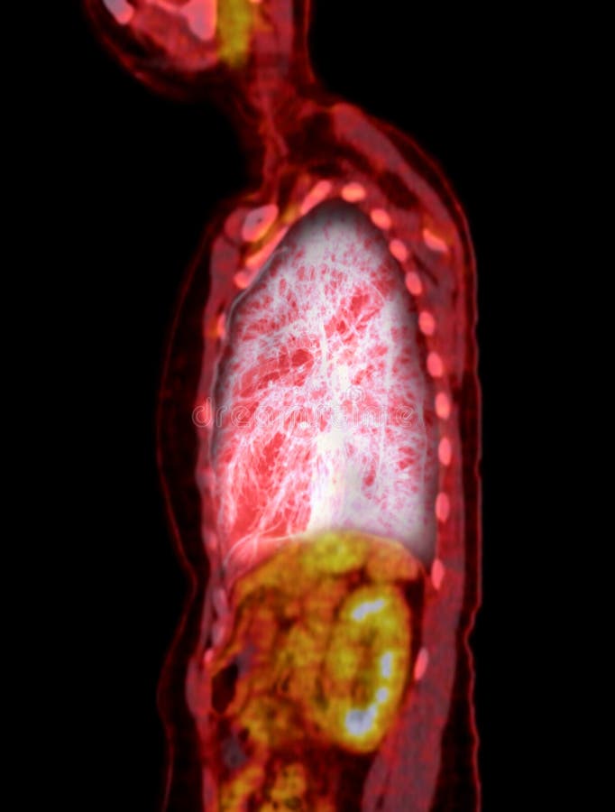 A PET-CT Scan Image is a Diagnostic Visualization Combining Positron ...