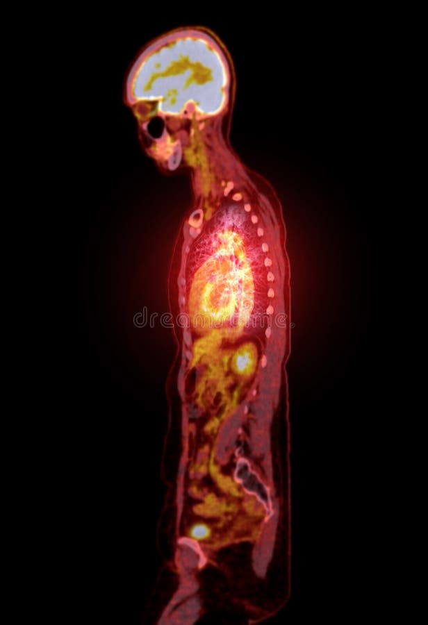 A PET-CT Scan Image is a Diagnostic Visualization Combining Positron ...