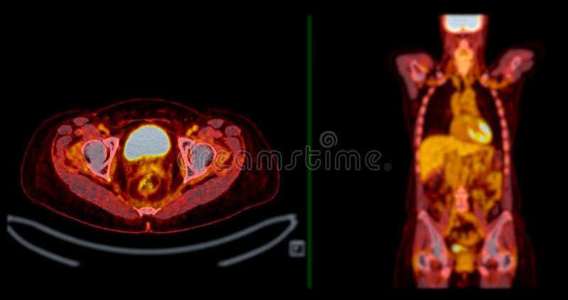 A PET-CT Scan Image is a Diagnostic Visualization Combining Positron ...
