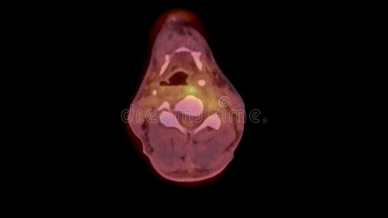 A PET-CT Scan Image is a Diagnostic Visualization Combining Positron ...