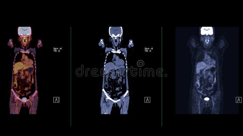 A PET-CT Scan Image is a Diagnostic Visualization Combining Positron ...