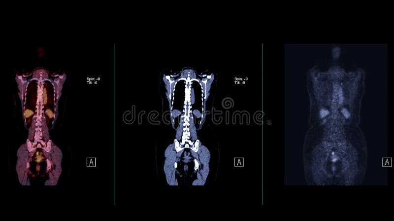 A PET-CT Scan Image is a Diagnostic Visualization Combining Positron ...