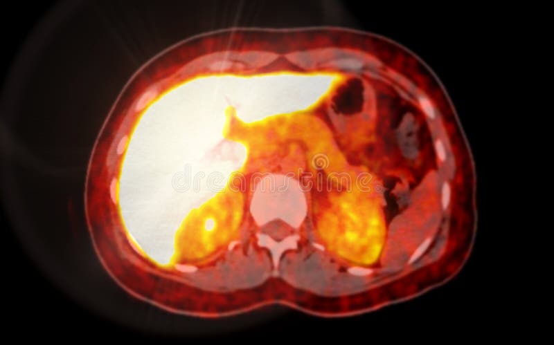 A PET-CT Scan Image is a Diagnostic Visualization Combining Positron ...