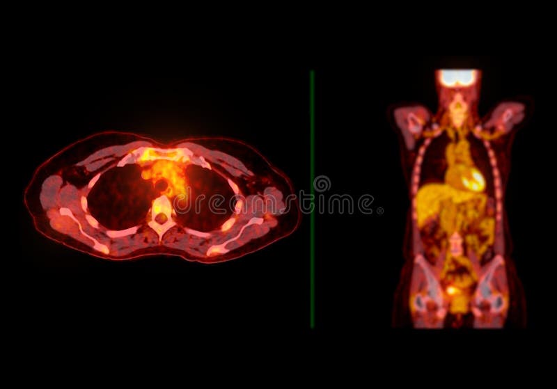 A PET-CT Scan Image is a Diagnostic Visualization Combining Positron ...
