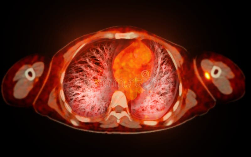 A PET-CT Scan Image is a Diagnostic Visualization Combining Positron ...