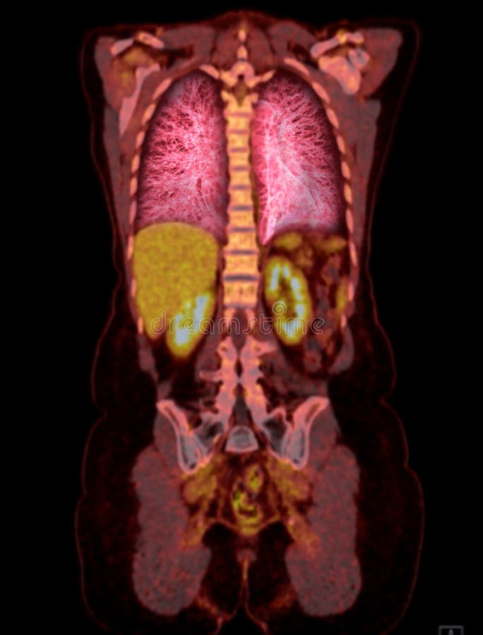 A PET-CT Scan Image is a Diagnostic Visualization Combining Positron ...