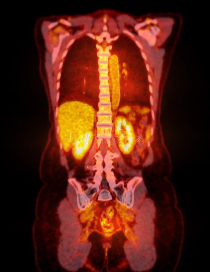 A PET-CT Scan Image is a Diagnostic Visualization Combining Positron ...
