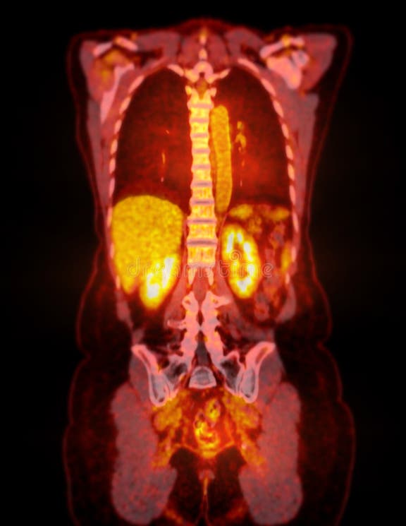 A PET-CT Scan Image is a Diagnostic Visualization Combining Positron ...