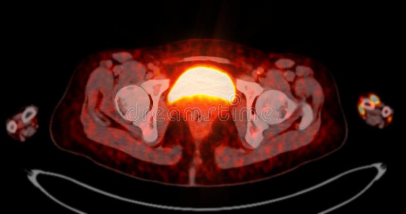 A PET-CT Scan Image is a Diagnostic Visualization Combining Positron ...