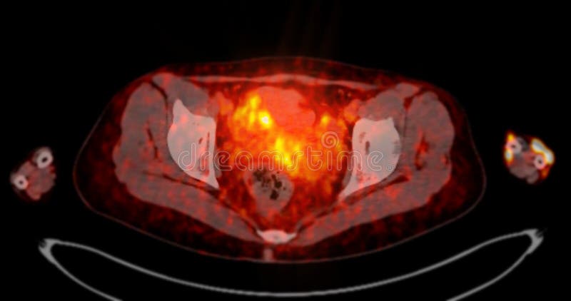 A PET-CT Scan Image is a Diagnostic Visualization Combining Positron ...