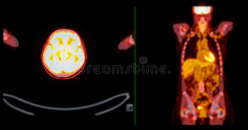 A PET-CT Scan Image is a Diagnostic Visualization Combining Positron ...