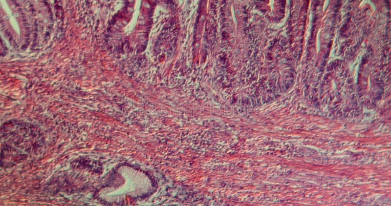 Peuz-Jaeger Polyp Growth at High Magnification Stock Footage - Video of ...