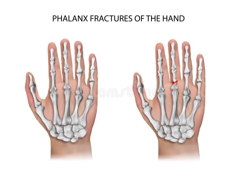 Phalanx Fractures of the Hand. Stock Illustration - Illustration of ...