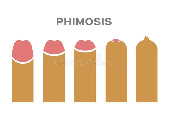 Phimosis Type on White Background Stock Vector - Illustration of ...