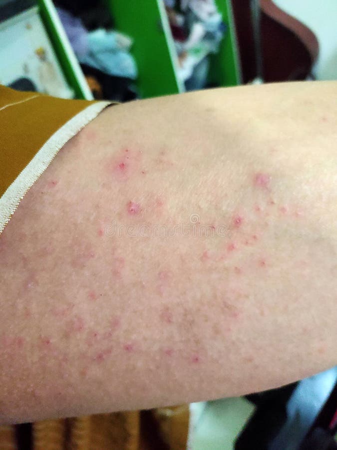 Photo Itchy Disease Caused by Fleas Scabies Stock Image - Image of ...