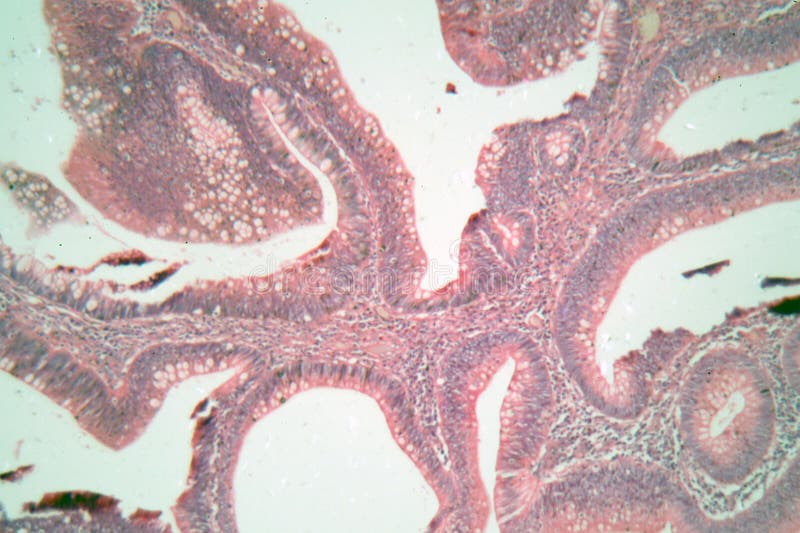 Photo of Large Intestine Cells. Stock Photo - Image of pathology, sign ...