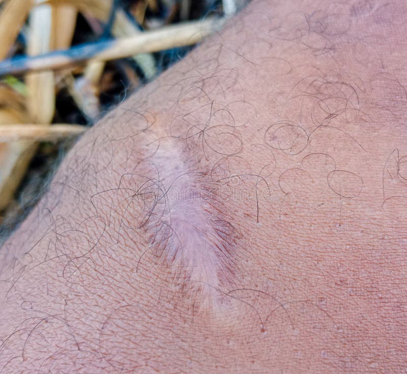 This is a Photo of the Unstitched Wound Stock Image - Image of head ...