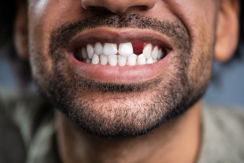 446 Man Missing Tooth Stock Photos - Free & Royalty-Free Stock Photos ...